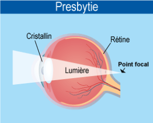 La presbytie - Retina France