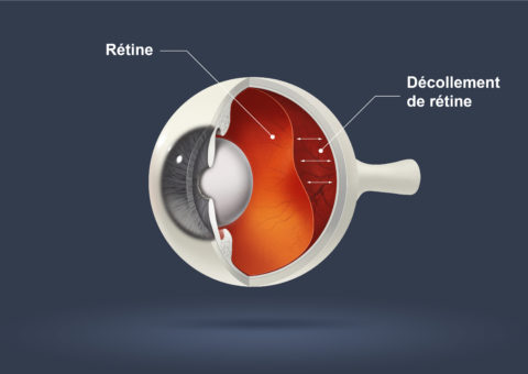 Le décollement de rétine : urgence ophtalmique - Retina France