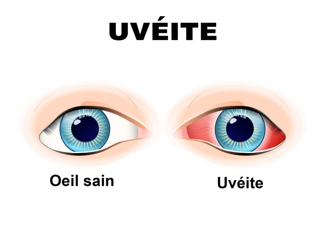 Uvéite : une inflammation oculaire à prendre au sérieux - Retina France